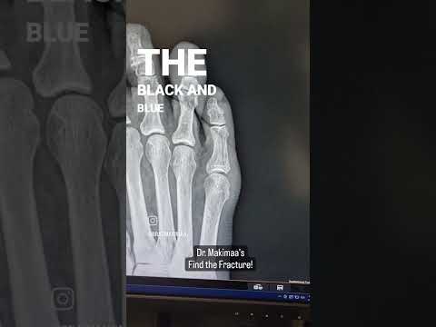 Find the Fracture! 5th proximal phalanx