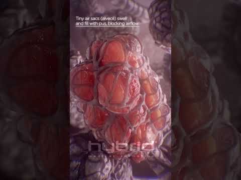 Pneumonia & alveoli up close | medical animation | #pneumonia #pneumoniaanimation #medicalanimation