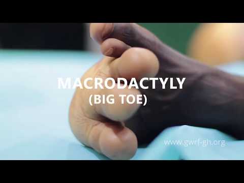 Case of the Day - Macrodactyly