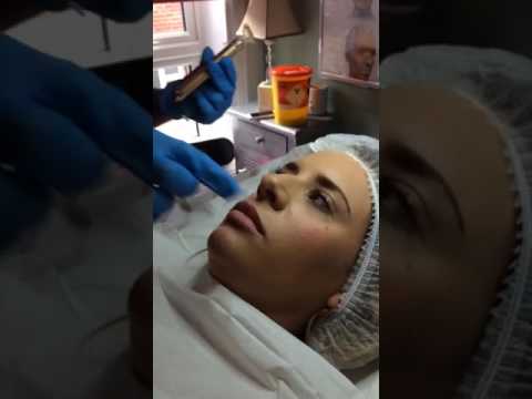 Lip filler using intraline 2