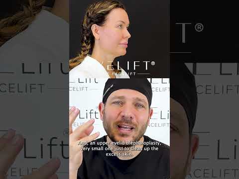 49-Year-Old EVE Lift™ Patient Before and After | Eden Plastic Surgery: Dr. Ali Charafeddine, MD