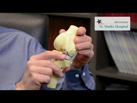 What Is the Difference Between a Total and Partial Knee Replacement?
