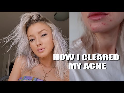 products that helped clear my acne | lolaliner