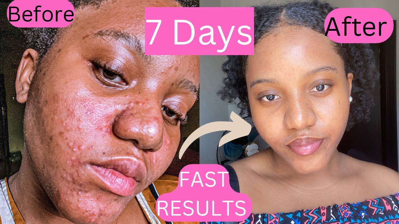 HOW TO REALLY CLEAR YOUR ACNE IN ONE WEEK (NO ACCUTANE) GUARANTEED RESULTS!