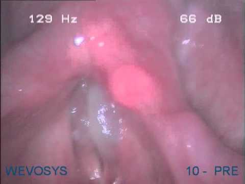 10 - Bilateral Reinke's edema - pre - ROVD