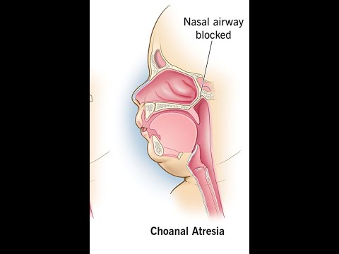 Repair choanal atresia CPT code - simplify medical coding