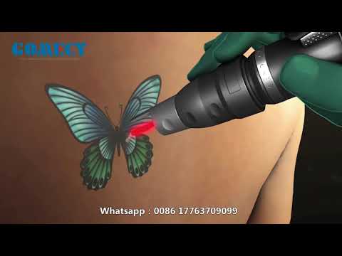 Cynosure PicoSure Tattoo Removal