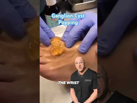 Popping Jelly-Filled Ganglion Cyst #shorts