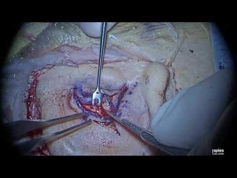External Auditory Canal Atresiaplasty