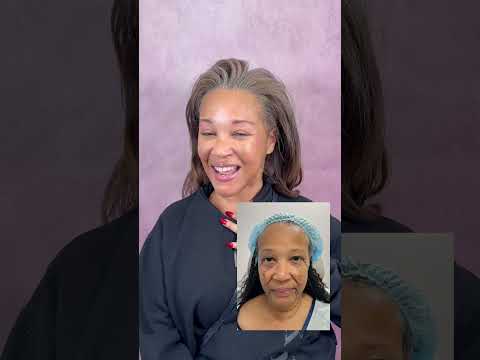 Facelift Takes Off 20 Years 🤯 Life Changing Plastic Surgery