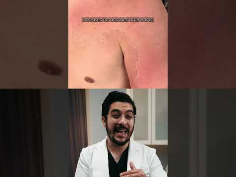 Dermatologist Reacts to a Severe Sunburn!
