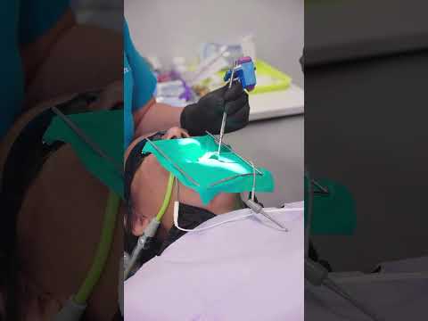 root canal procedure in Brickell Dental Care💎 #dentistry #dentist #dayinlife