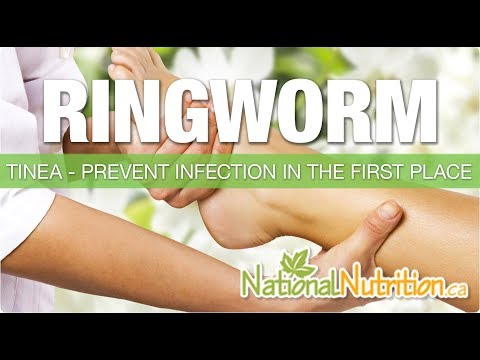 Natural Remedies for Ringworm From NationalNutrition.ca - National ...
