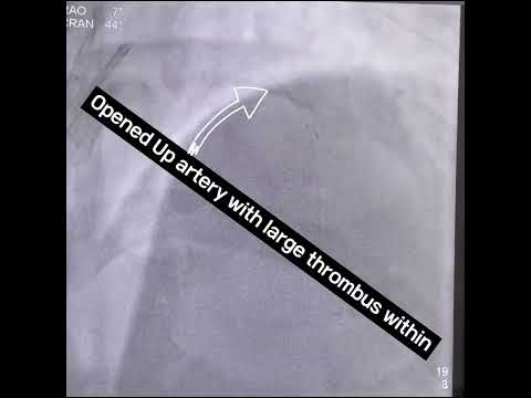 Primary Angioplasty