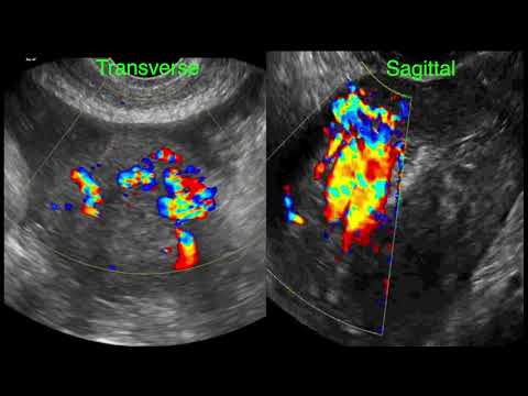 Enhanced Myometrial Vascularity: Case Presentation and Review