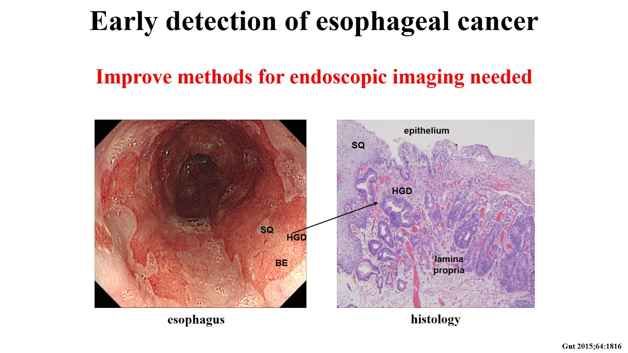 Thomas Wang - Early Cancer Detection in the Digestive Tract