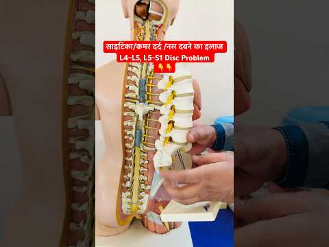 Treatment for back pain / sciatica / compression of back nerve. L4-L5, L5-S1 Disc Problem #trendi...