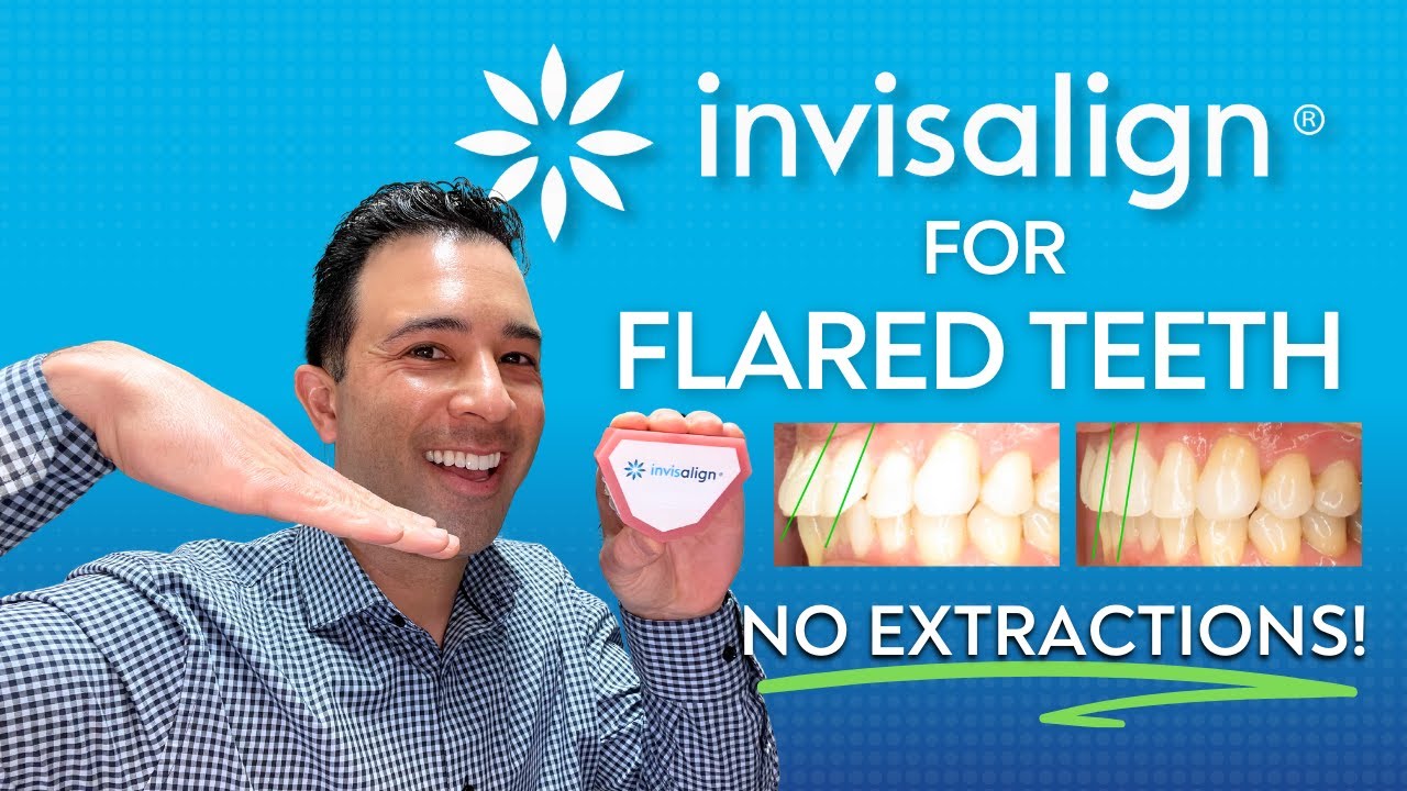 Fix Your Flared Teeth With Invisalign WITHOUT Extractions! (Invisalign and IPR Method)