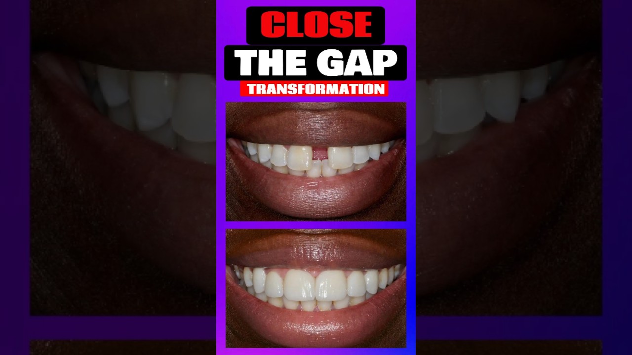 Close spaces and gaps between your teeth with porcelain veneers