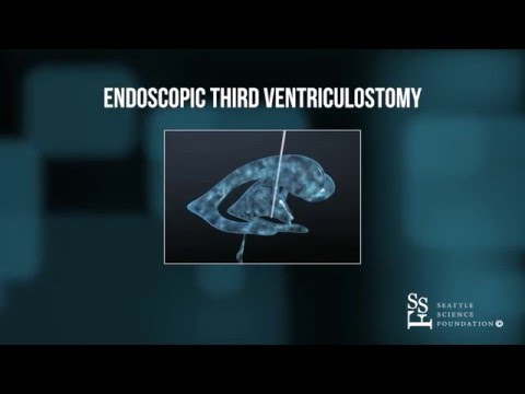 Endoscopic Third Ventriculostomy Animation