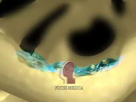 Postmenopausal Osteoporosis