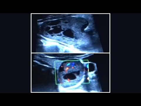 Parathyroid Adenoma ultrasound in a hypercalcemic patient