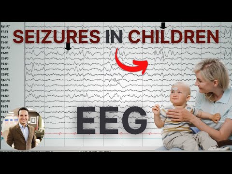 Epilepsy in Children - SLECTS on EEG