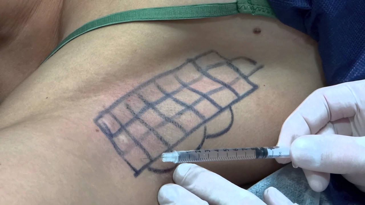 Como eliminar el sudor, Hiperhidrosis axilar sudoración excesiva, tratamiento medico con botox