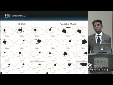 Expectations & Limitations of Embolization for AVM by Adnan Siddiqui, M.D.