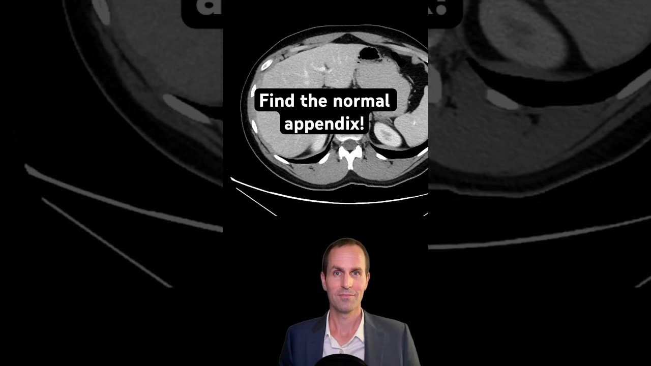 Abdominal CT Tutorials - Find the Normal Appendix!
