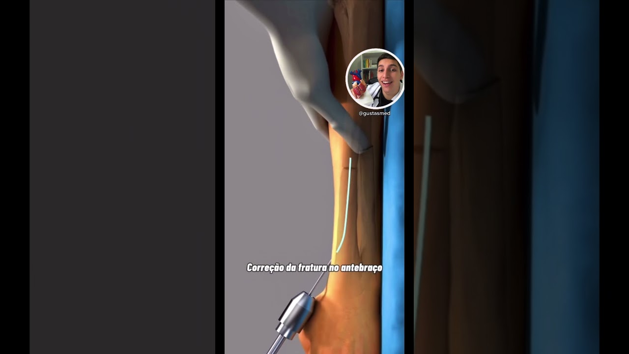 Correção de fratura do antebraço #saúde #saude #dicas #curiosidades