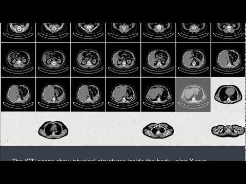 PET CT (English Subtitles)