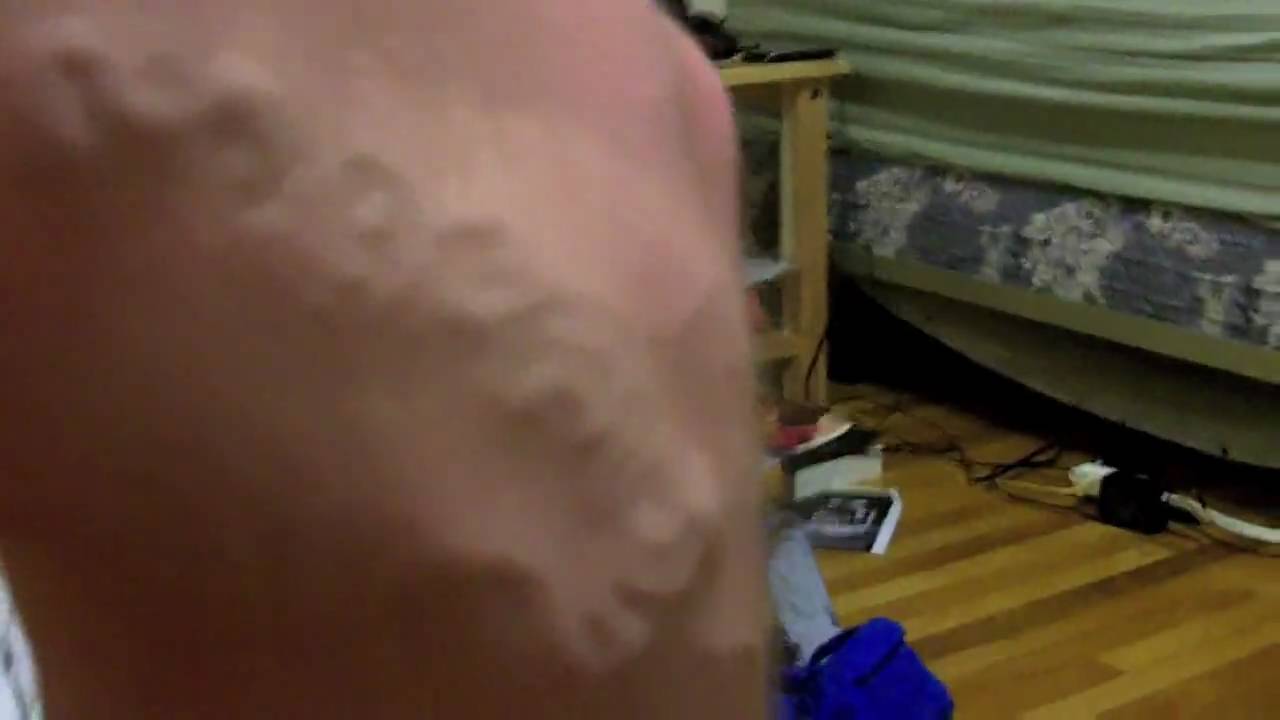 ATTACK OF THE VEIN