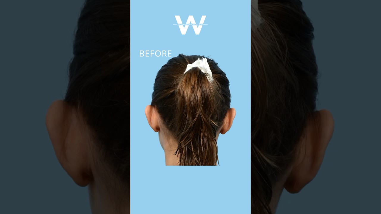 Ear pinning with an Otoplasty procedure is a great way to fix your ear shape and from sticking out!