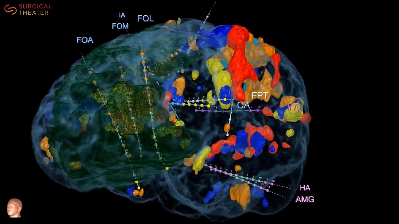 Corewell Health uses virtual and augmented reality in neurosurgery ...