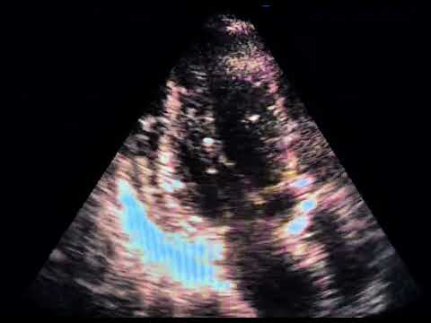 Cardiac Metastatic Calcification: A Marker of Underlying Systemic Disease