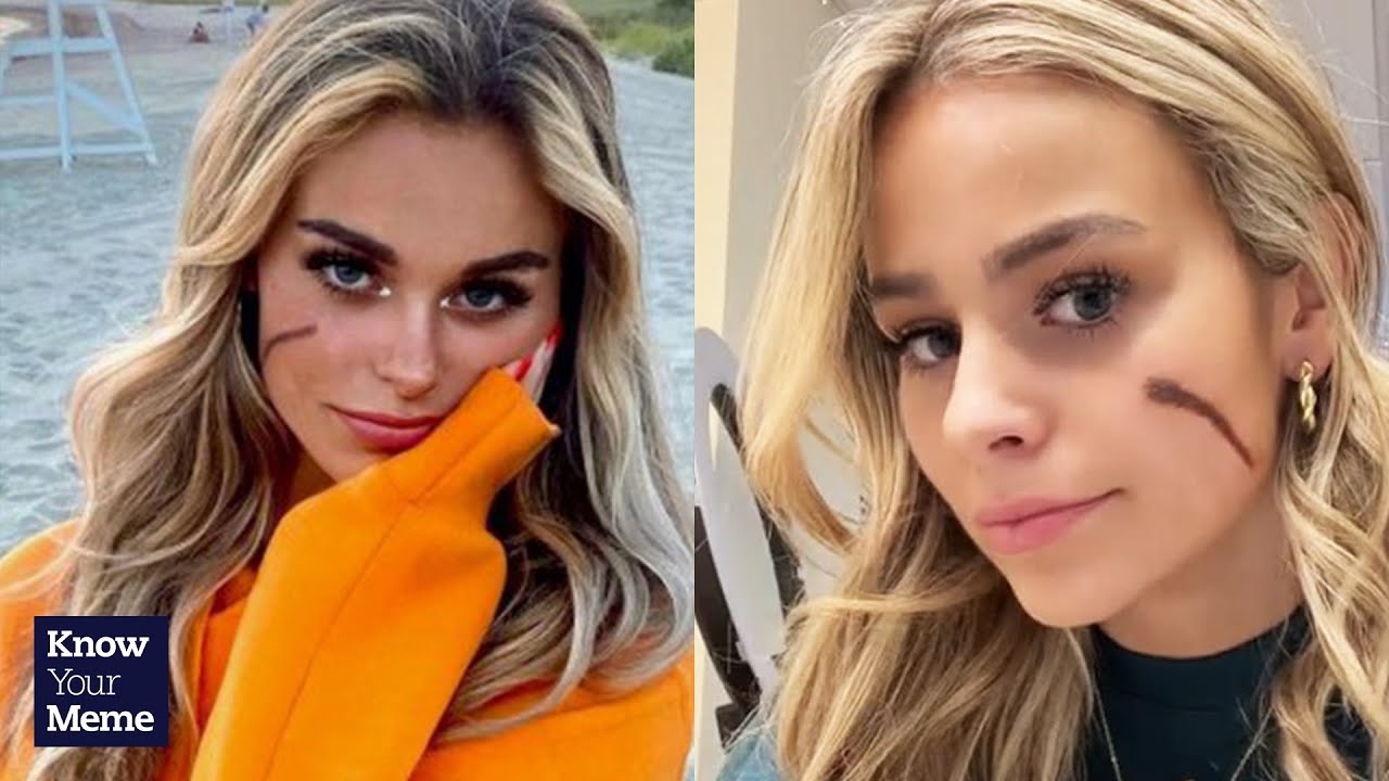 Scar Girl Accused of Faking Her Scar