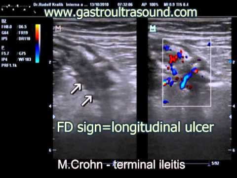Crohn s Terminal Ileitis Longitudinal Ulcers