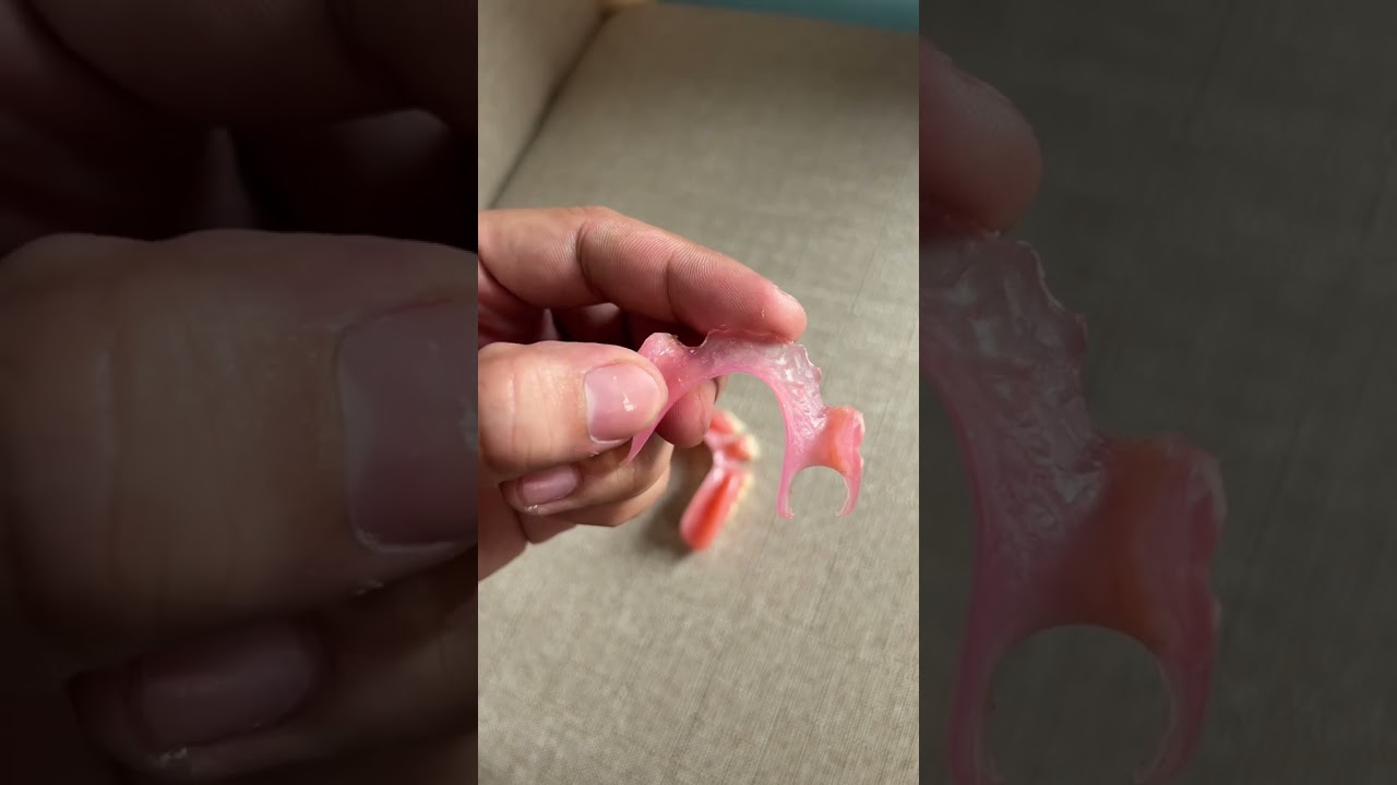 FLEXIBLE VS ORDINARY DENTURE (pustiso)