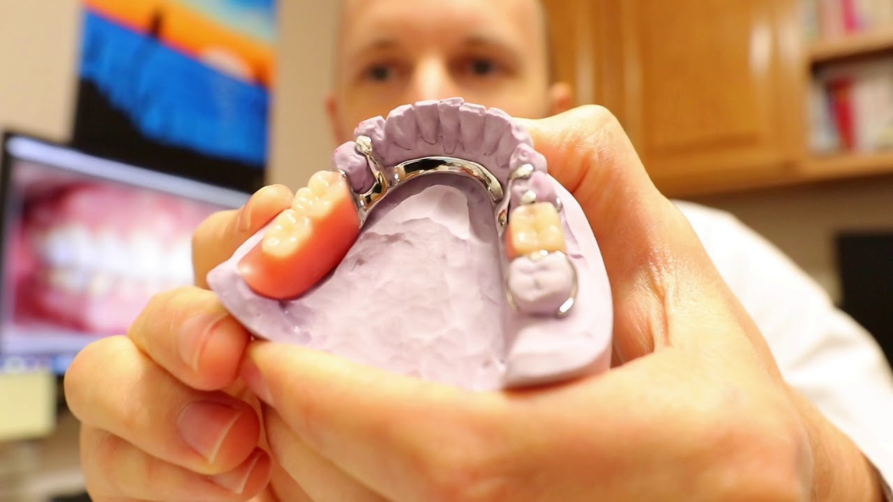 What is a Denture Try-in?