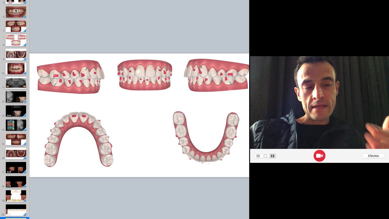 OPEN BITE, CLASS II. INVISALIGN TREATMENT. PROTOCOL