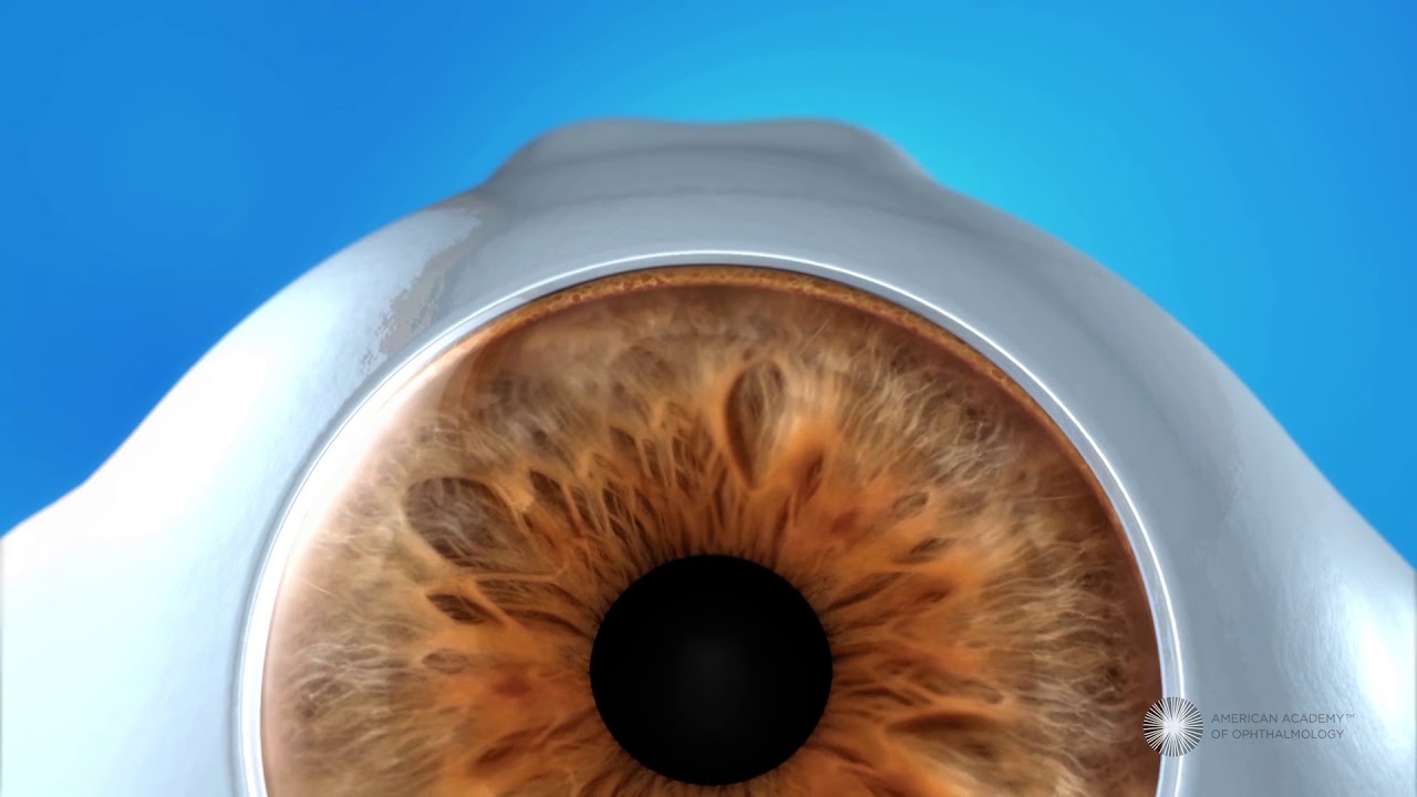 What is a trabecular bypass stent?