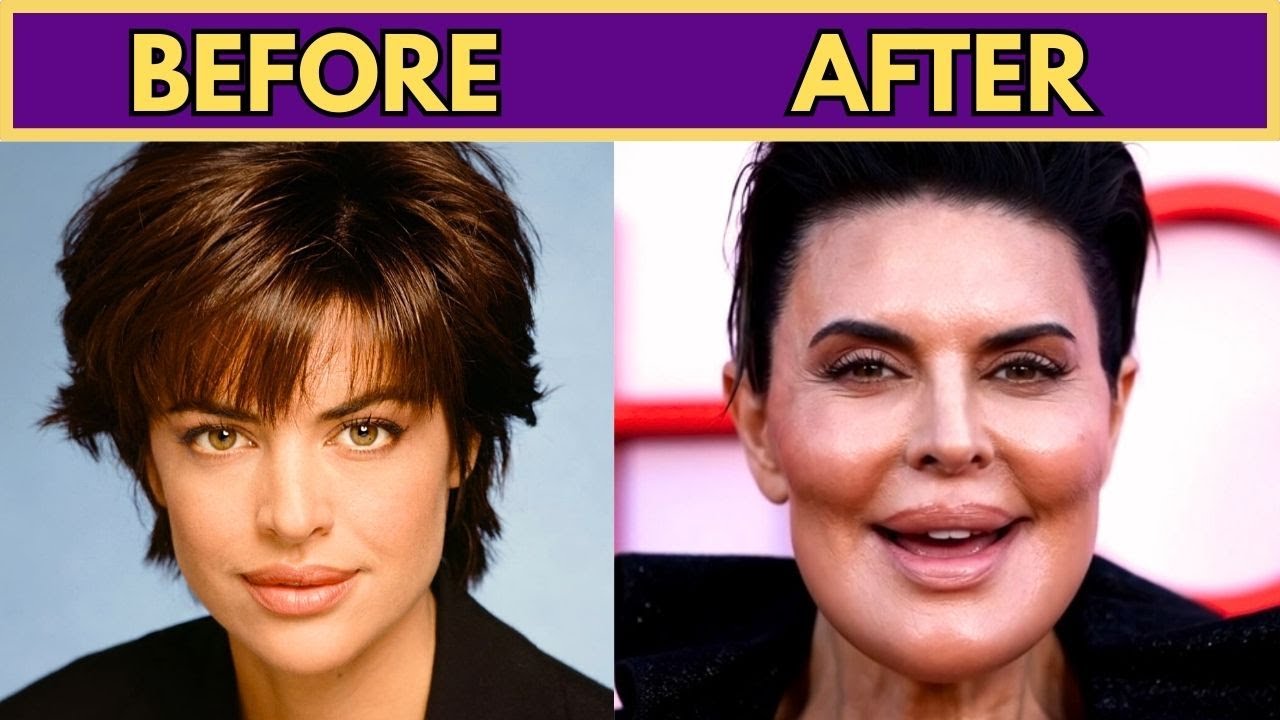 BEFORE & AFTER PLASTIC SURGERY — CELEBRITIES WHO LOOK TOTALLY DIFFERENT
