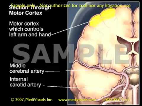 Transient Ischemic Attack and Stroke: Medical Animation