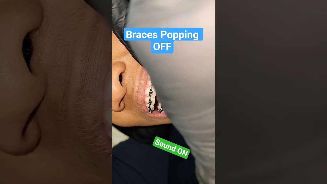Satisfying Braces Coming Off Sound | ASMR Dentistry with Dr. Dave at Smile Envy