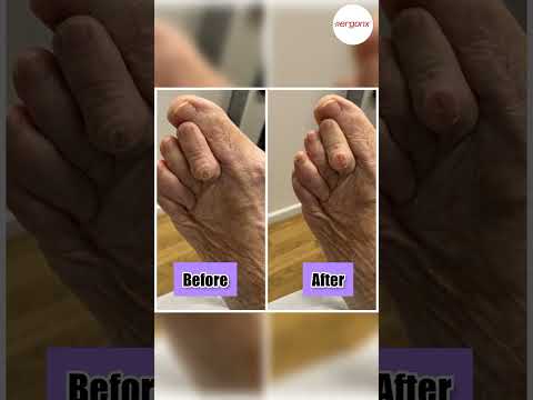 Ulcerating Corn on 2nd Toe