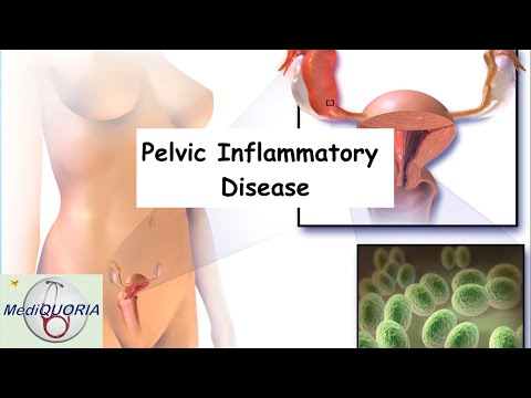 PID Health Education | Pelvic Inflammatory Disease