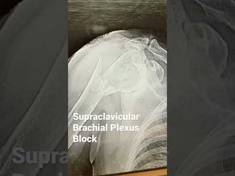 Supraclavicular Brachial Plexus Block #nerveblock