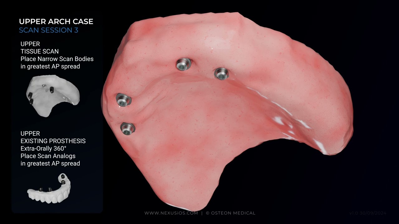 Nexus iOS - Definitive Protocol Screw Retained - Upper Arch