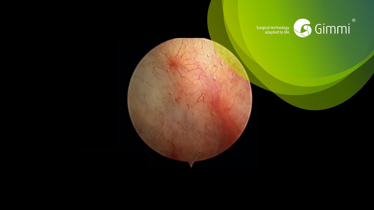 Gimmi – Interstitial Cystitis Diagnosis with AlphaScope™ II Cystoscope – Dr. Huda AL-Hamadany